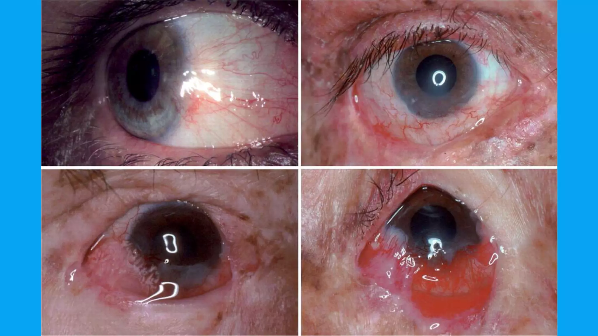 Xeroderma Pigmentosum | PPTX