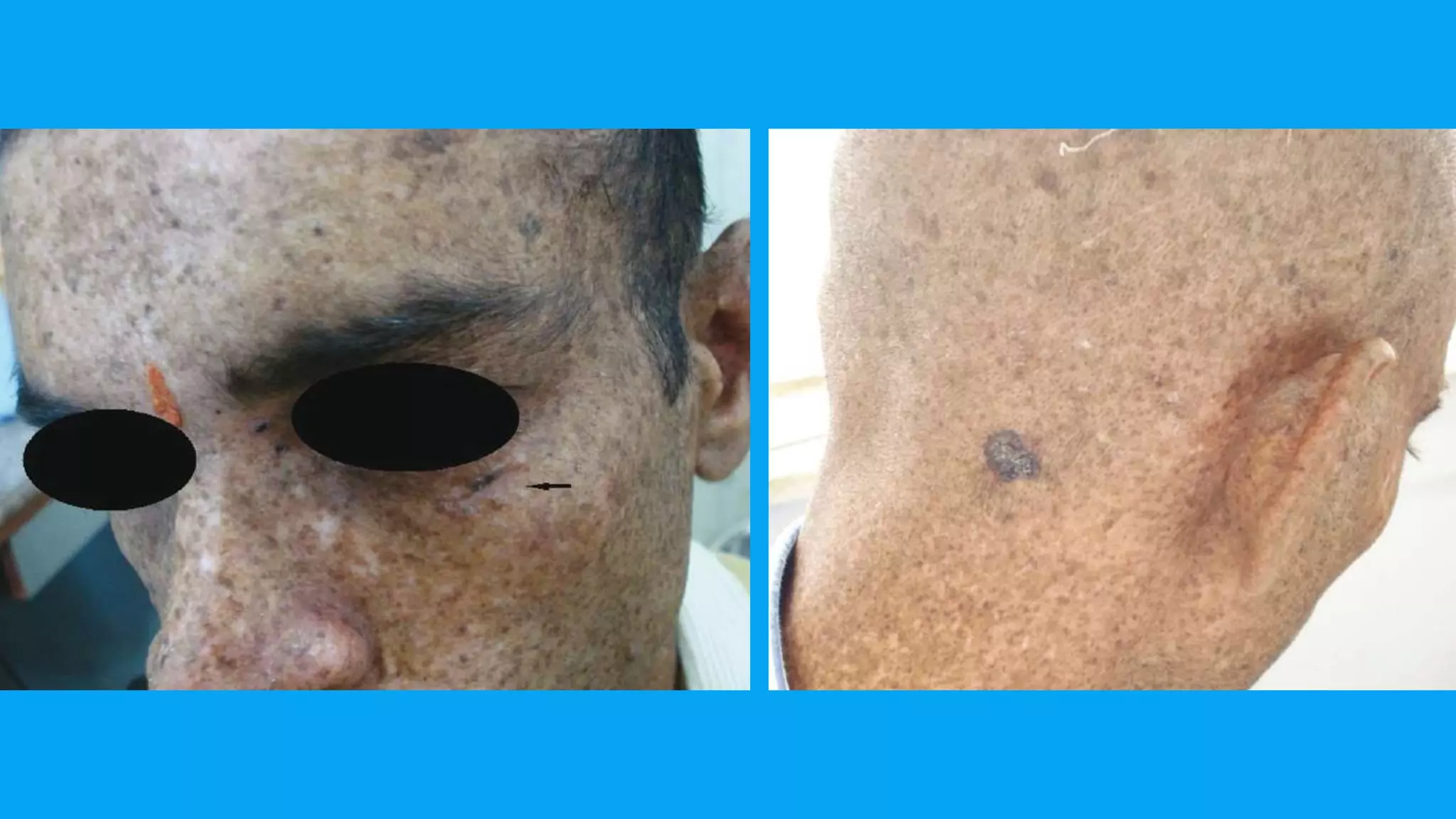 Xeroderma Pigmentosum | PPTX