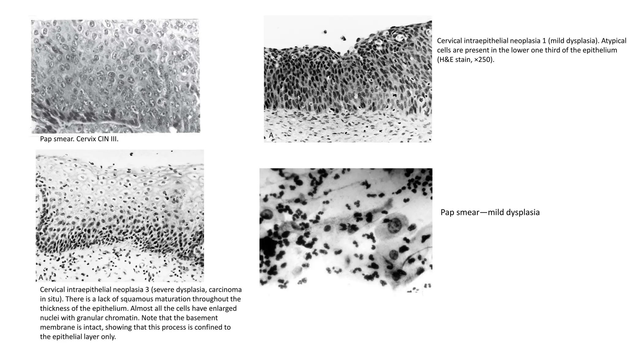Ca-Cx (Cervical Intraepithelial Neoplasia and Cervical Cancer).pptx