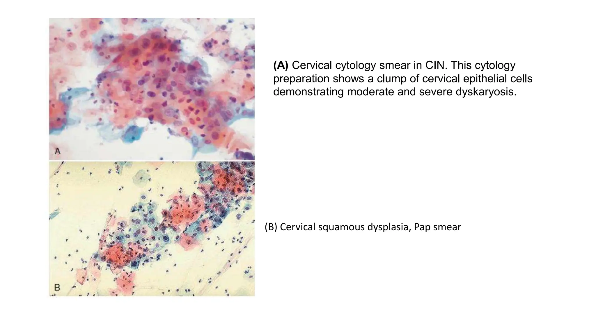 Ca-Cx (Cervical Intraepithelial Neoplasia and Cervical Cancer).pptx