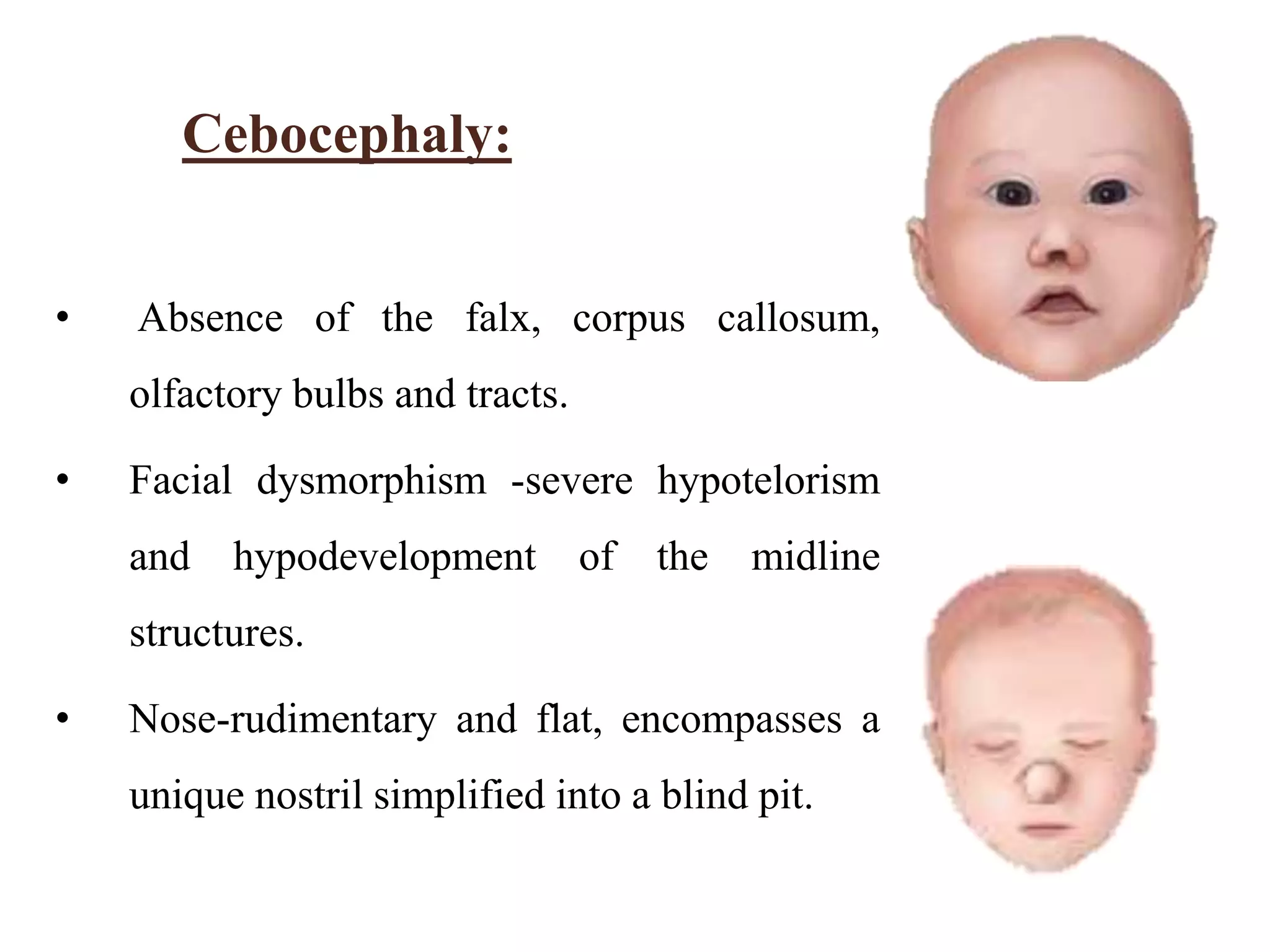 craniofacial anomalies | PPTX