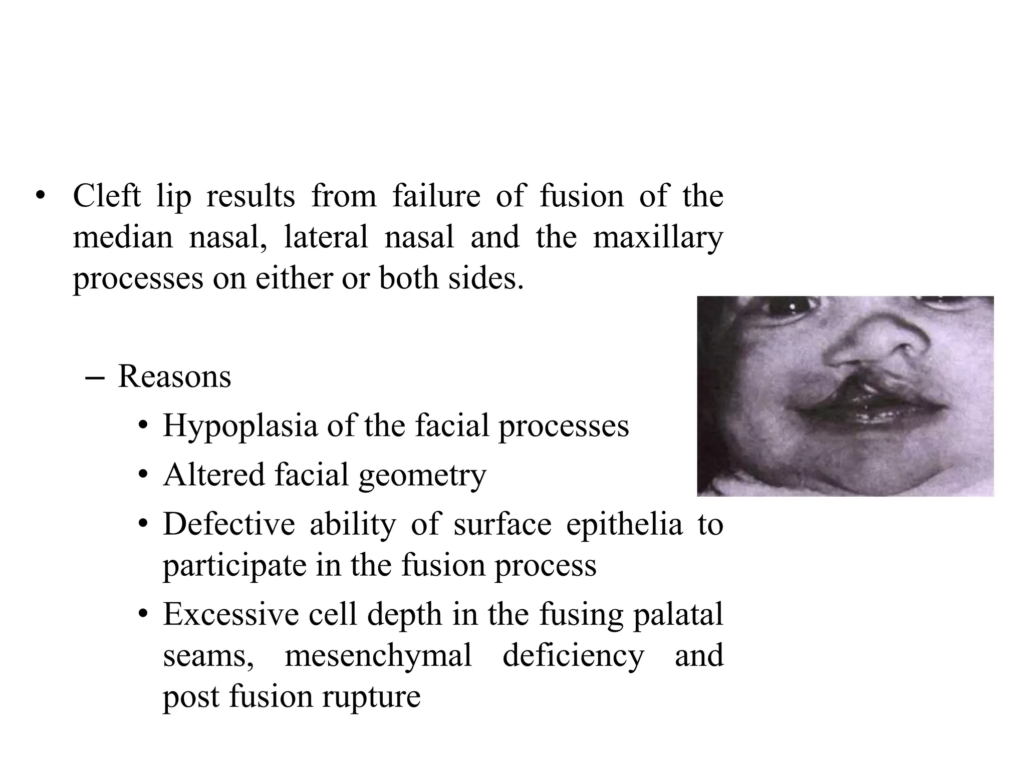 craniofacial anomalies | PPTX