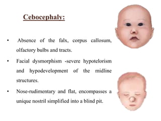 craniofacial anomalies | PPT