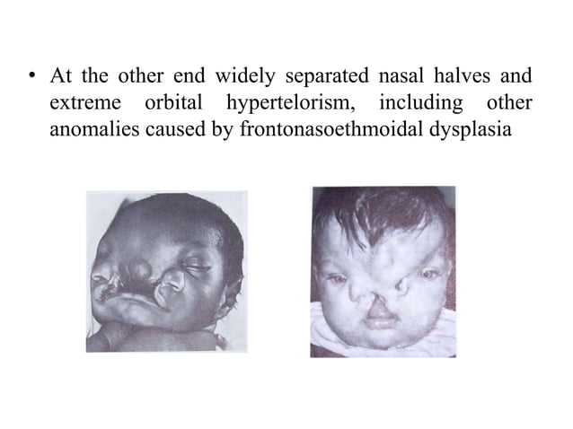 craniofacial anomalies | PPTX
