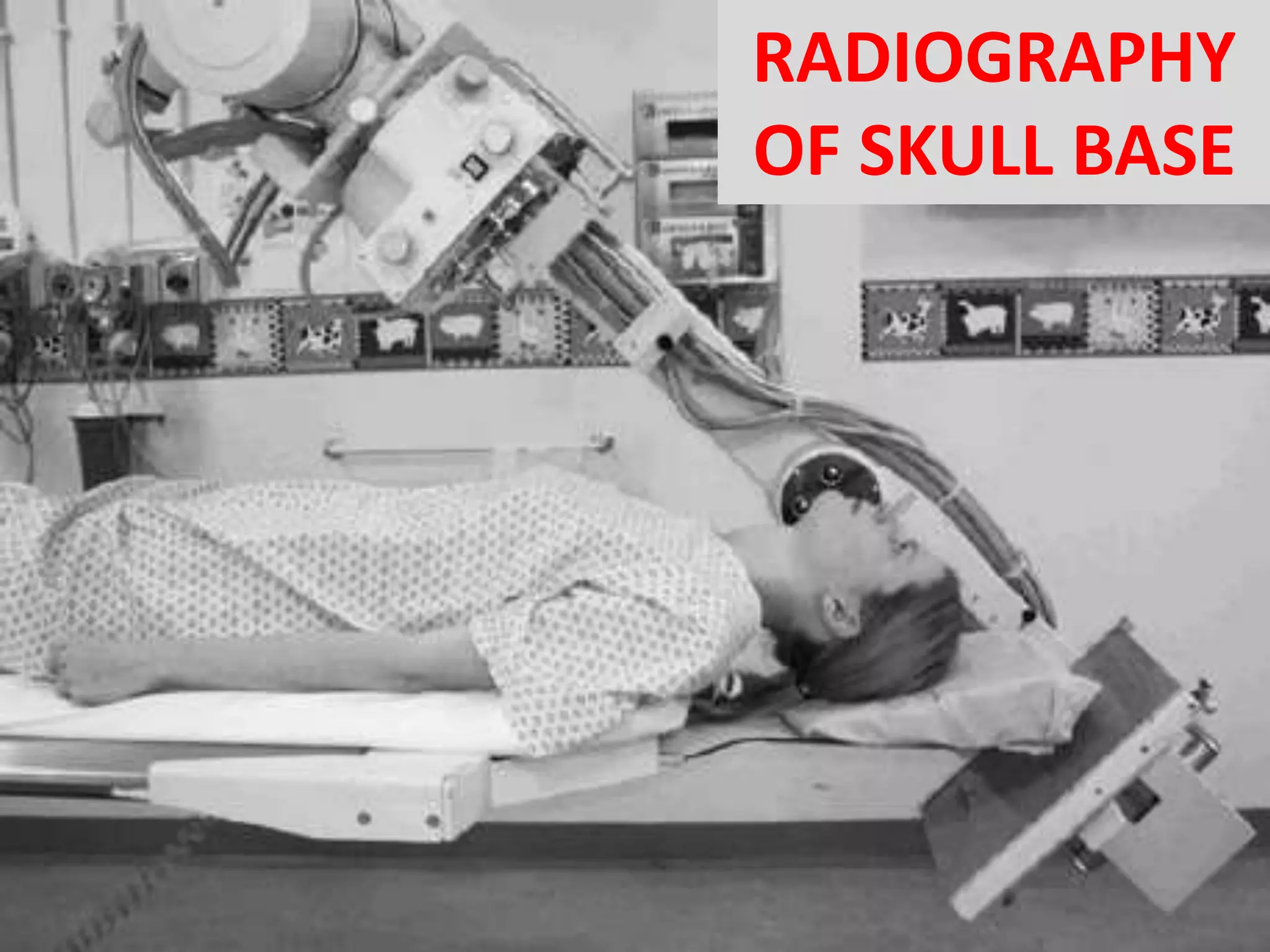 Imaging in Skull base | PPTX