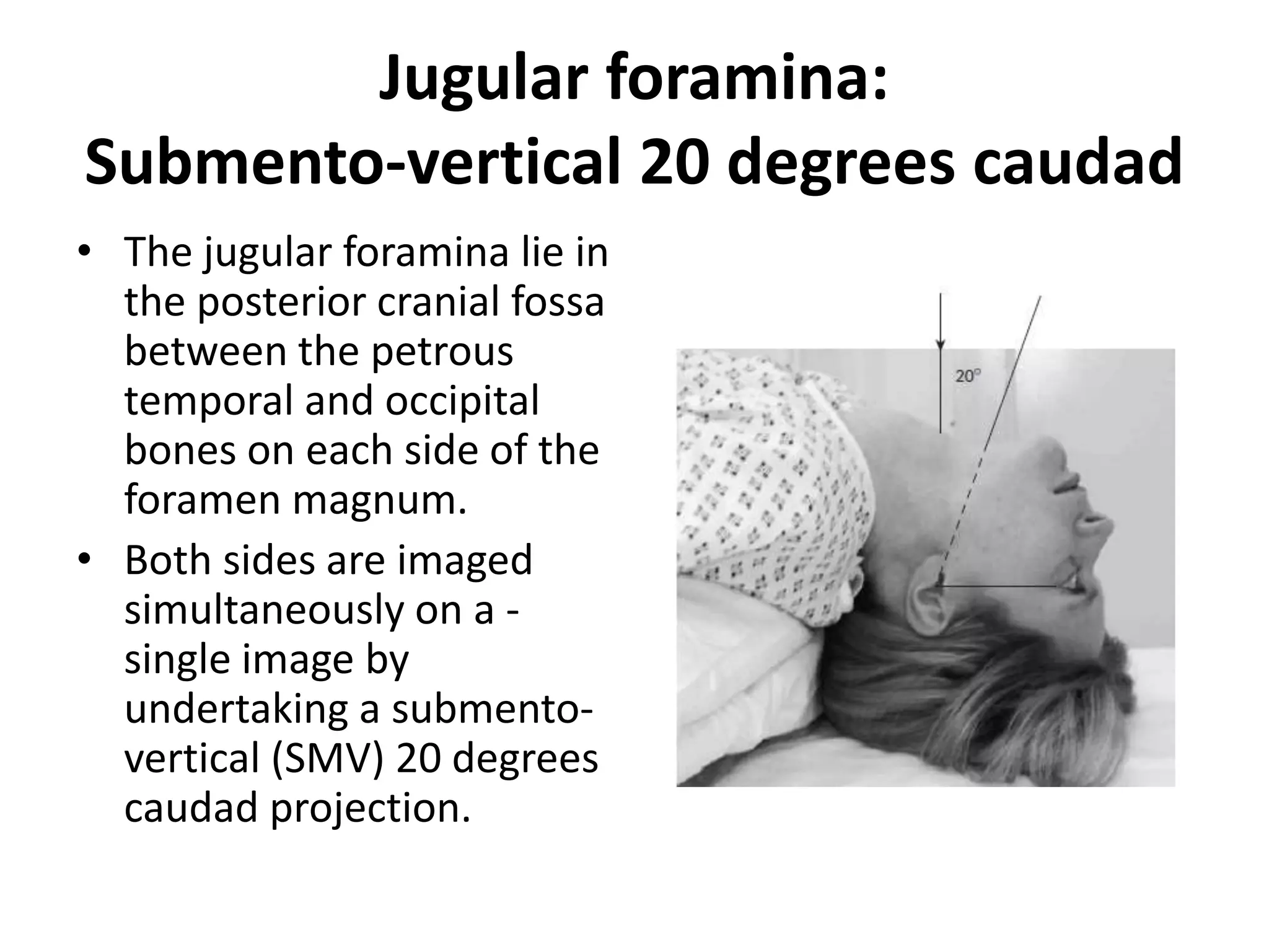 Imaging in Skull base | PPTX
