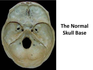 Imaging in Skull base | PPTX