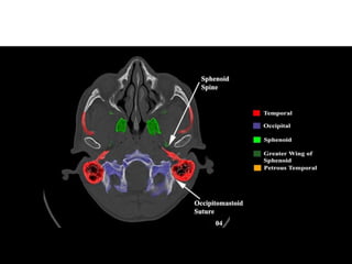 Imaging in Skull base | PPTX