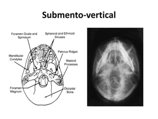 Imaging in Skull base | PPTX