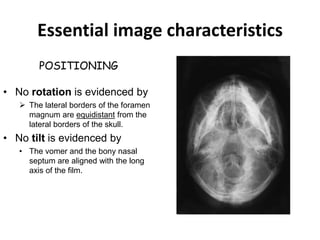 Imaging in Skull base | PPTX