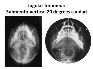 Imaging in Skull base | PPTX