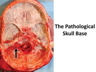 Imaging in Skull base | PPTX