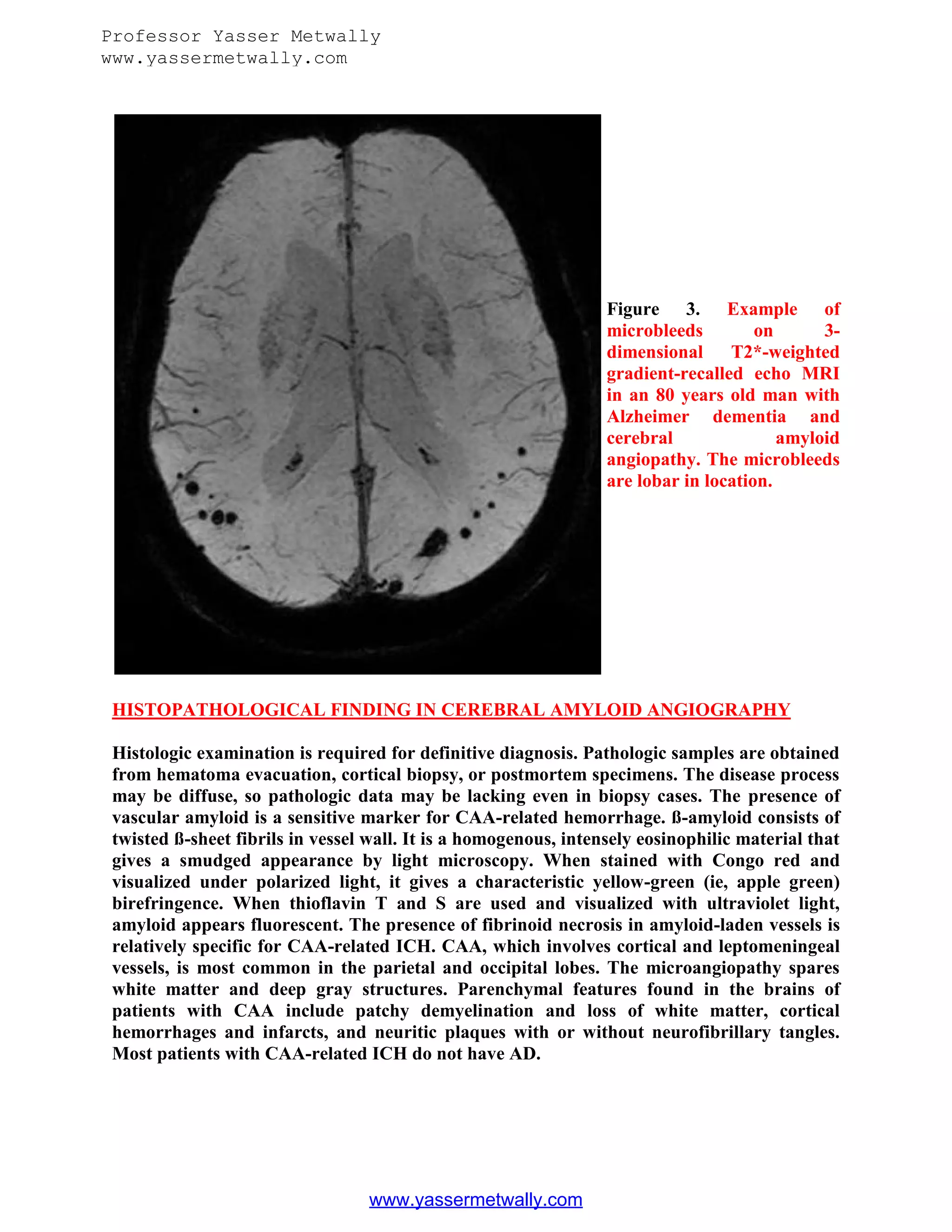 Radiological pathology of cerebral amyloid angiography | PDF