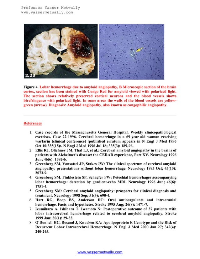 Radiological pathology of cerebral amyloid angiography | PDF