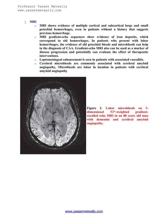 Radiological pathology of cerebral amyloid angiography | PDF