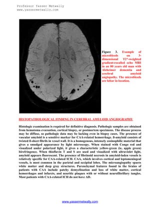 Radiological pathology of cerebral amyloid angiography | PDF | Blood ...
