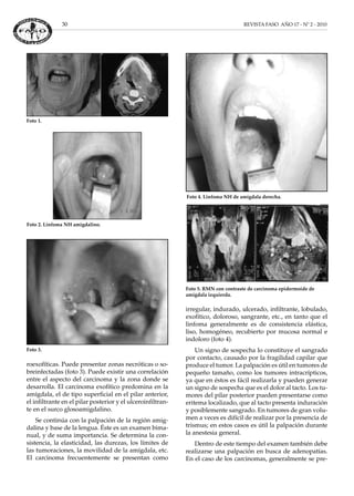 Cancer de amigdala | PDF