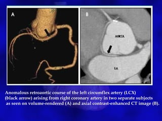 CA anomalies on CT angiography | PPT