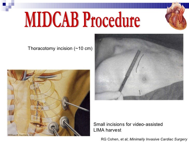 Coronary Artery Bypass Graft (CABG) - Desun Hospital Health Insight