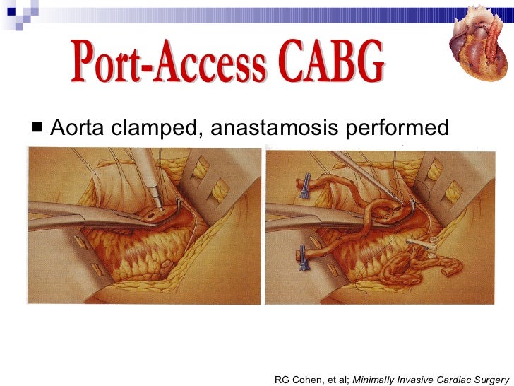 Coronary Artery Bypass Graft (CABG) - Desun Hospital Health Insight