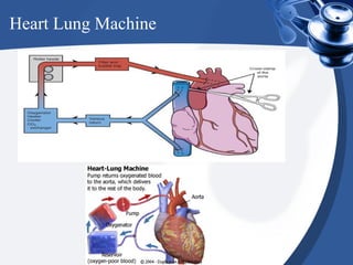 CABG | PPT