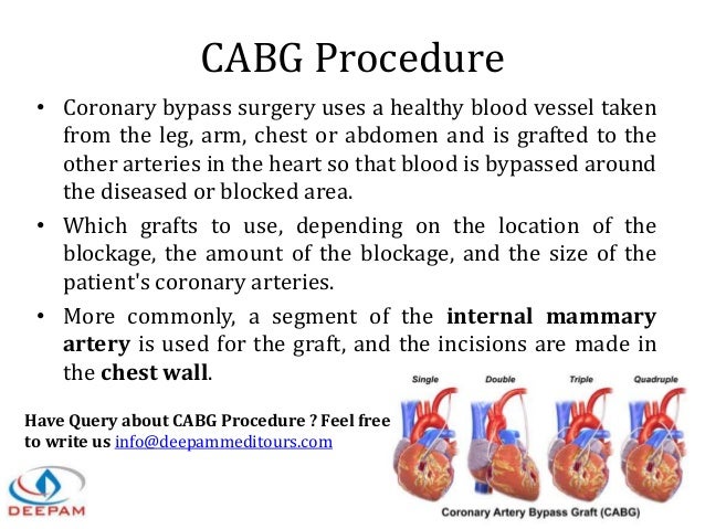 Things you need to know about CABG