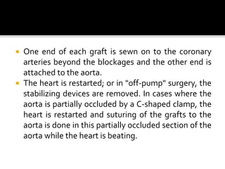 Coronary Artery Bypass Surgery (CABG) | PPTX
