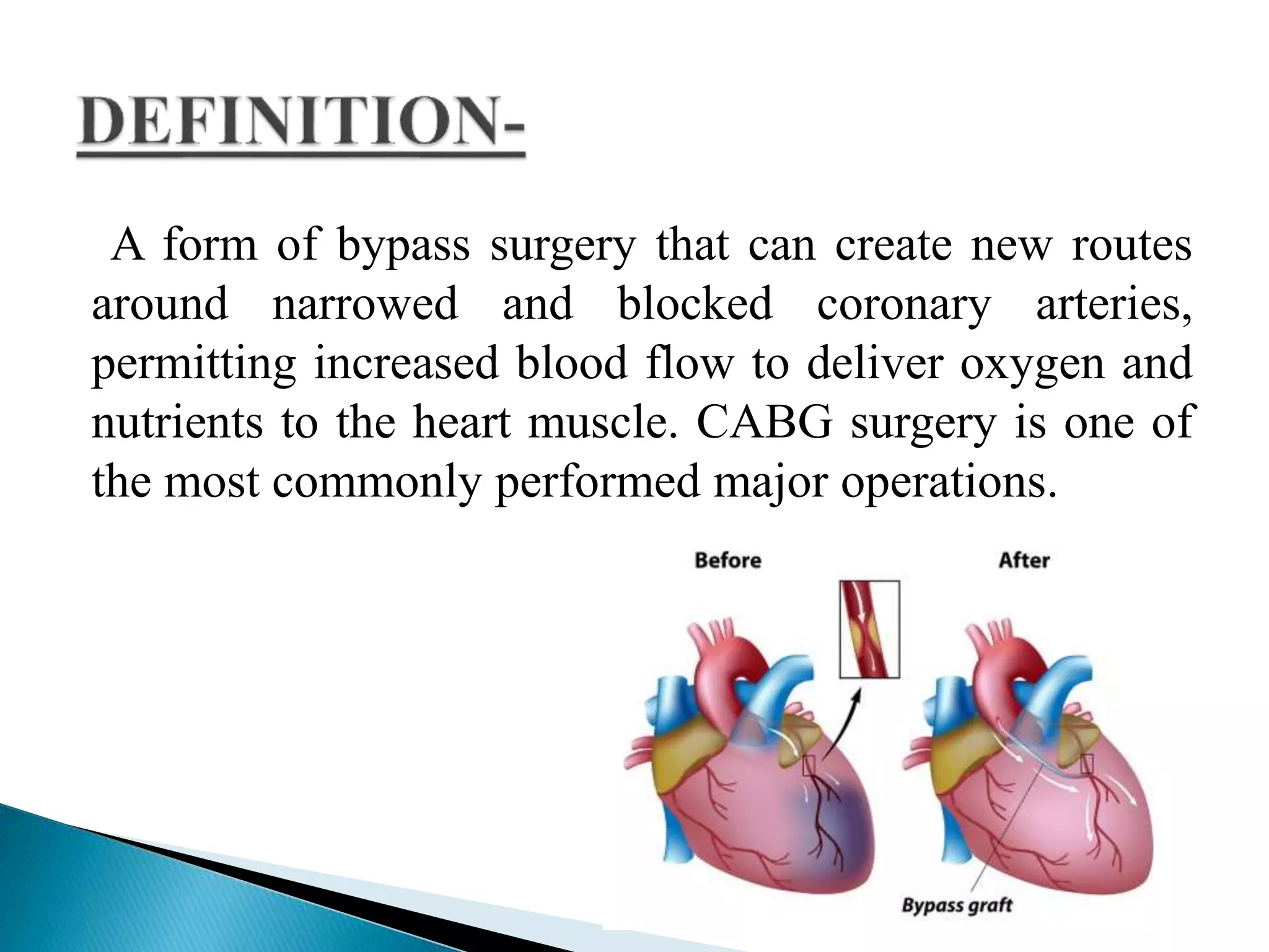 CABG | PPTX