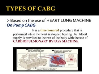CABG- Coronary Artery Bypass Grafting | PPTX | Heart and Cardiovascular ...