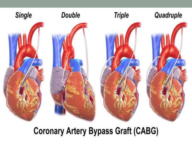 CORONARY ARTERY BYPASS GRATF ,,,,CARDIAC INTERVENTION ,,, | PPTX