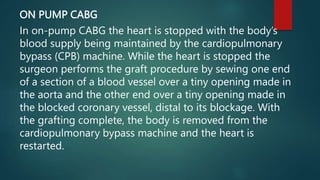 CABG | PPTX