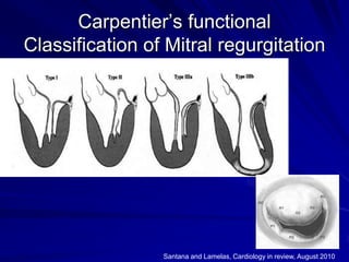 @Cabg and mitral | PPTX
