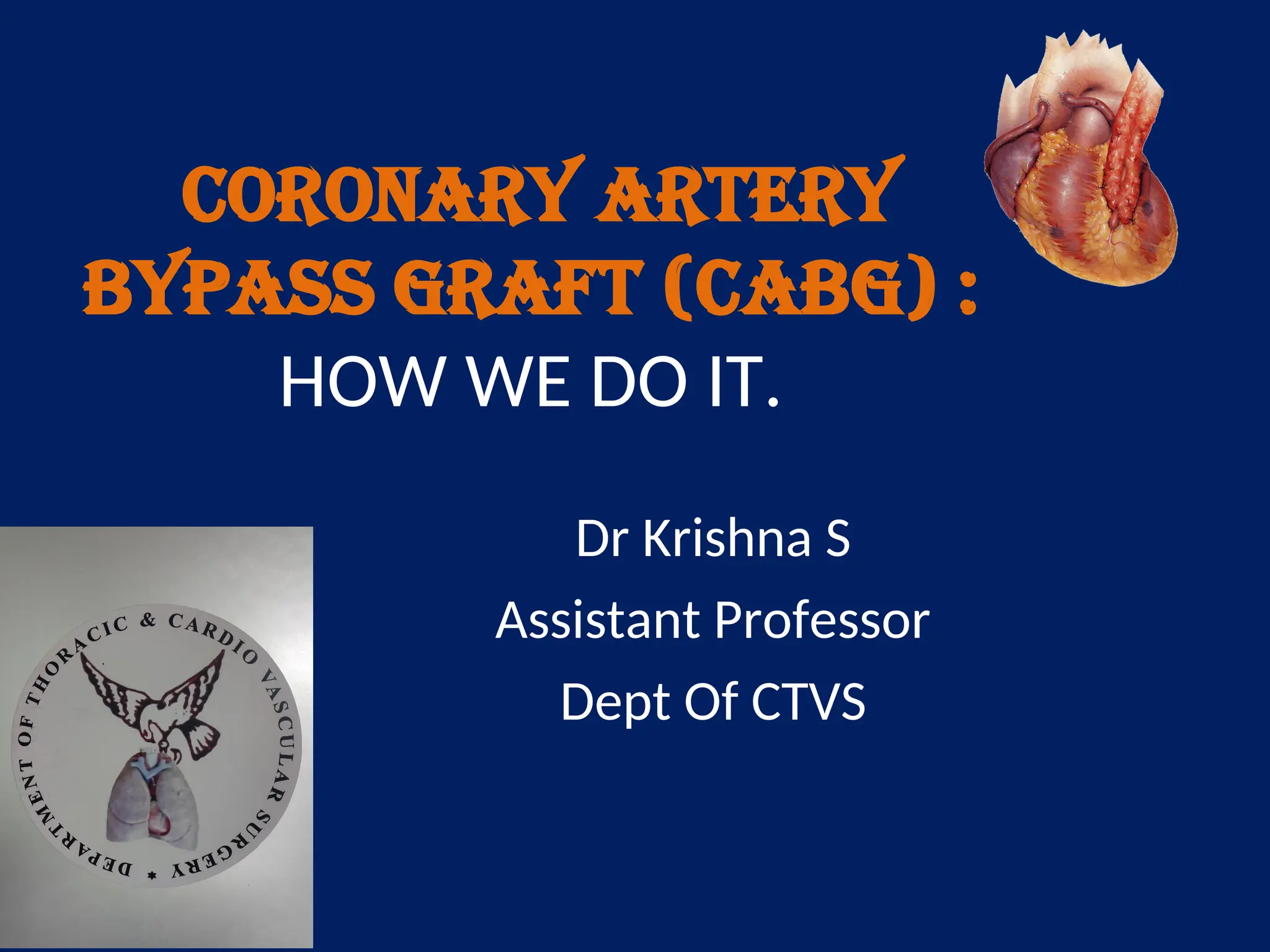 Cardio Pulmonary By Pass Graft (CABG) Indications and how we do it Dr ...