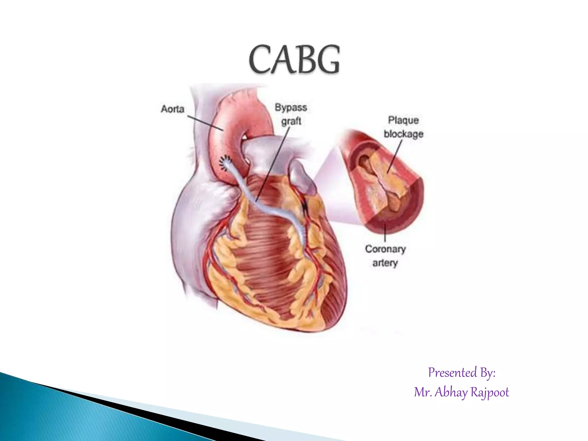 CABG | PPTX