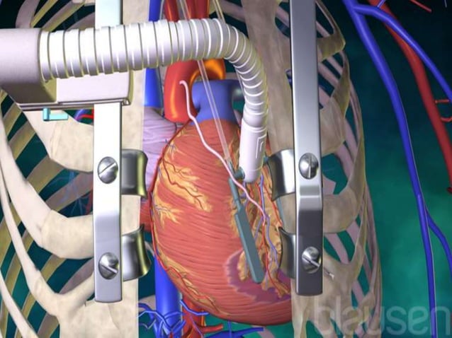 CABG | PPTX | Heart and Cardiovascular Diseases | Diseases and Conditions