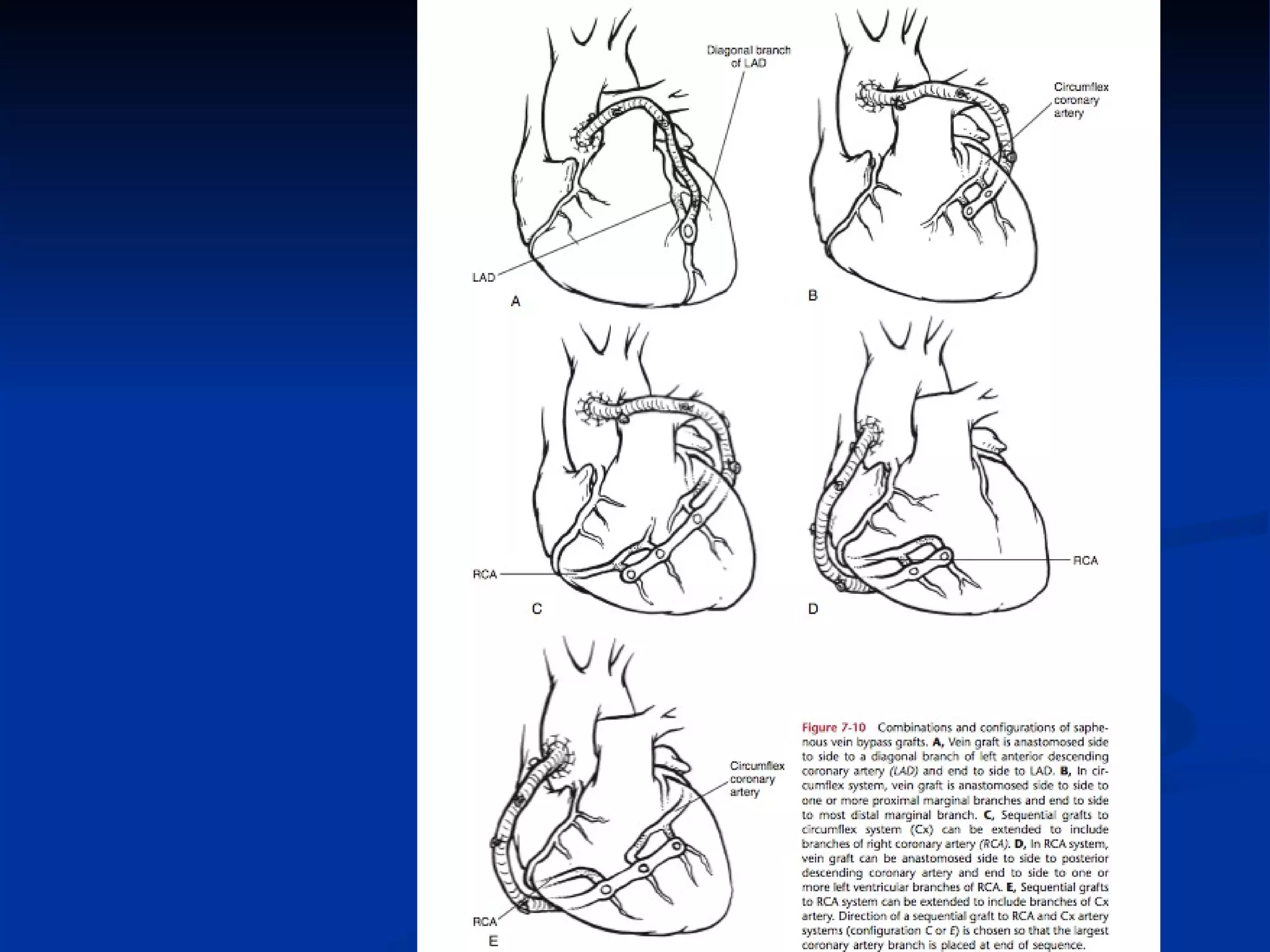 Coronary artery bypass grafting (CABG) | PPT