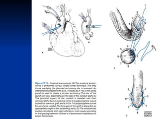 Coronary artery bypass grafting (CABG) | PPT
