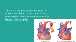 Coronary artery bypass graft ( CABG ) presentation | PDF