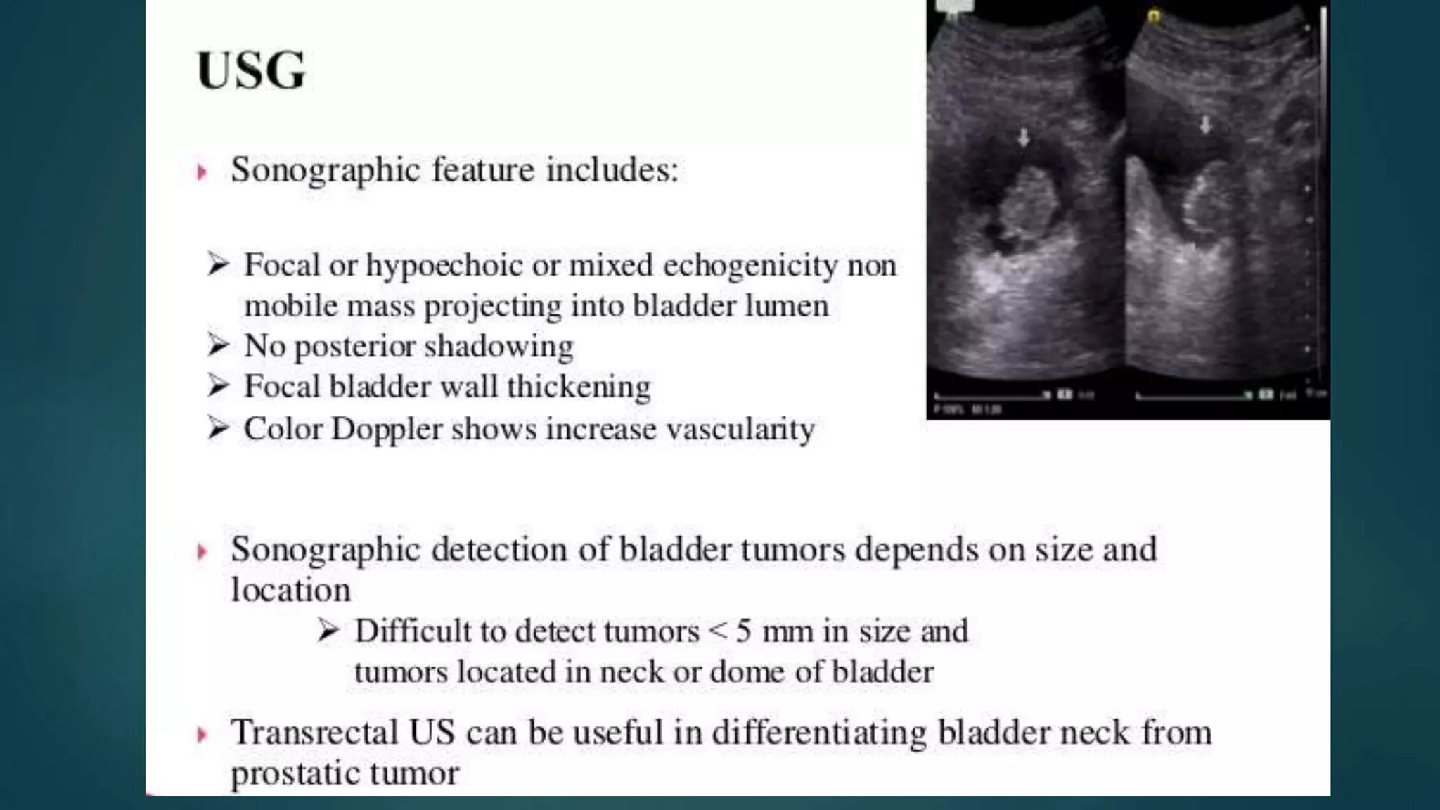 Ca bladder diagnosis | PPT
