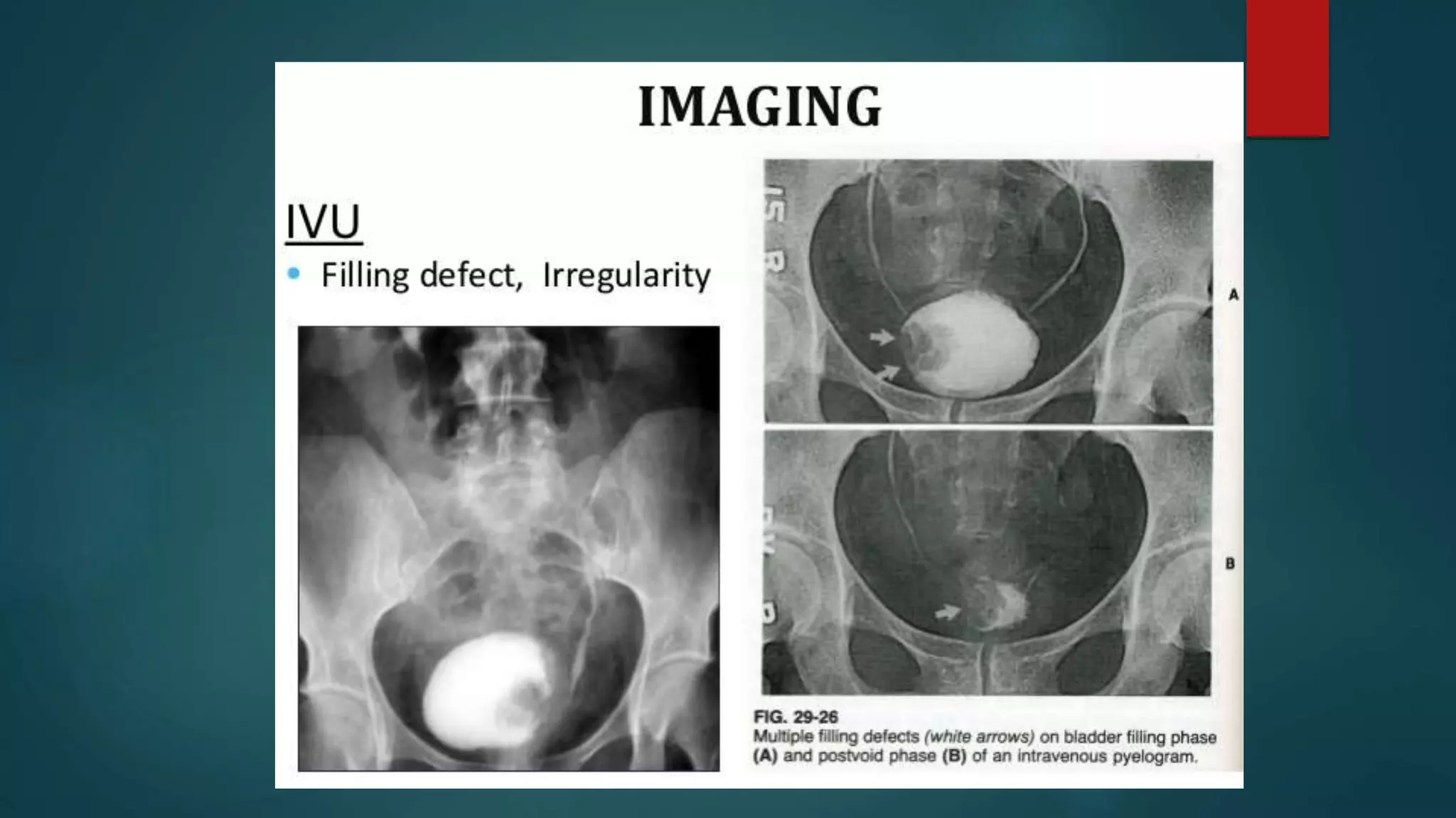 Ca bladder diagnosis | PPT