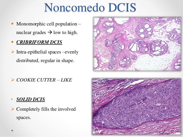 Ca breast molecular biology
