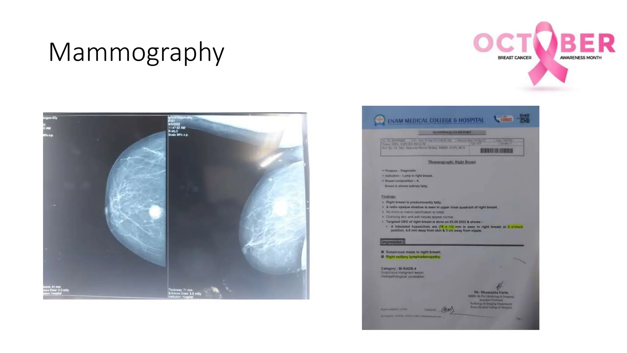 carcinoma breast case presentation .pptx