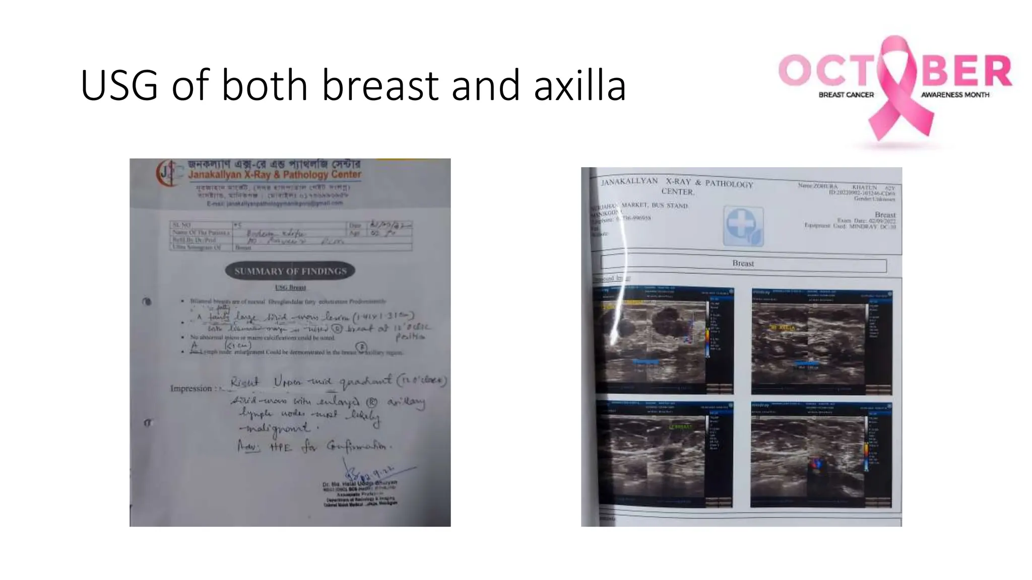 carcinoma breast case presentation .pptx