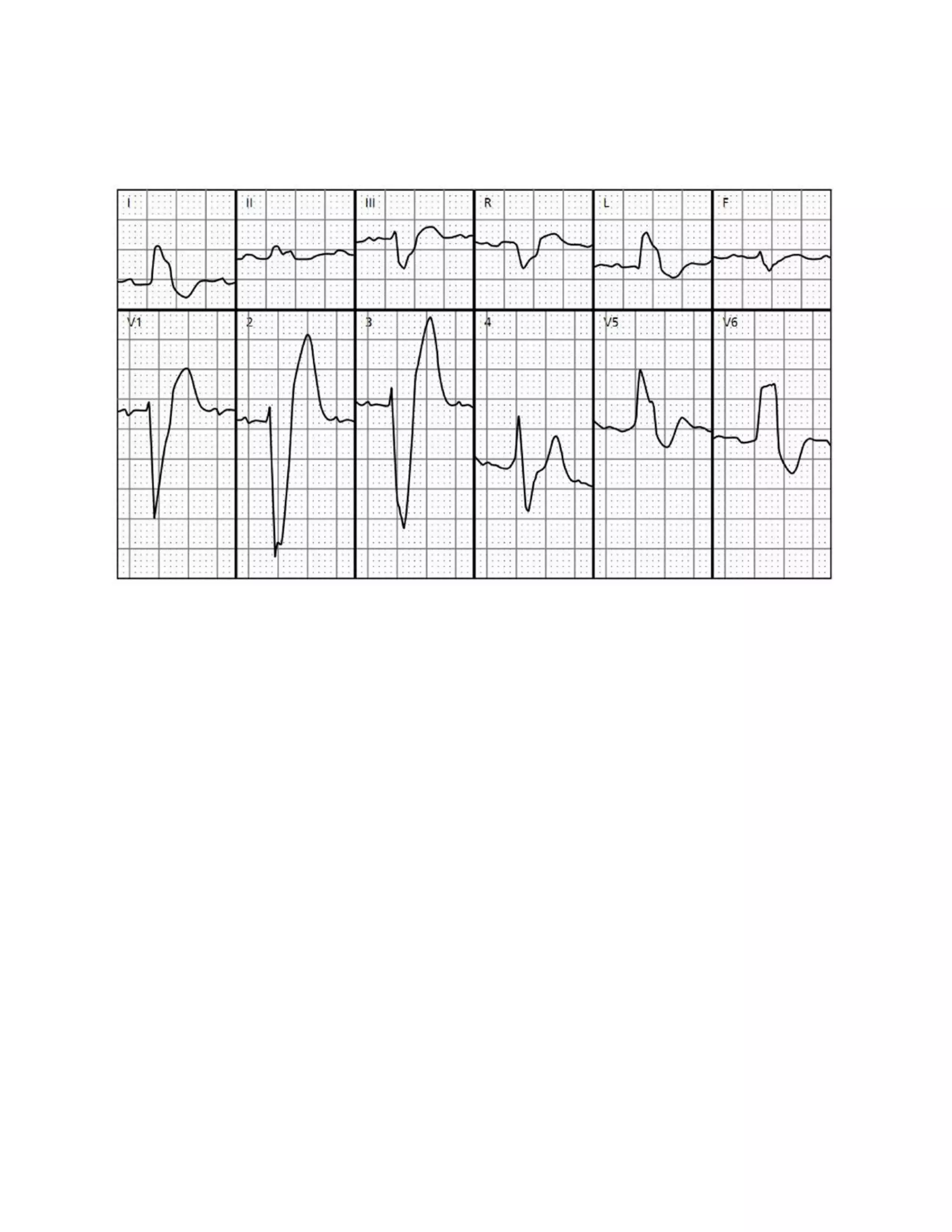 Cac buoc doc ecg | PDF