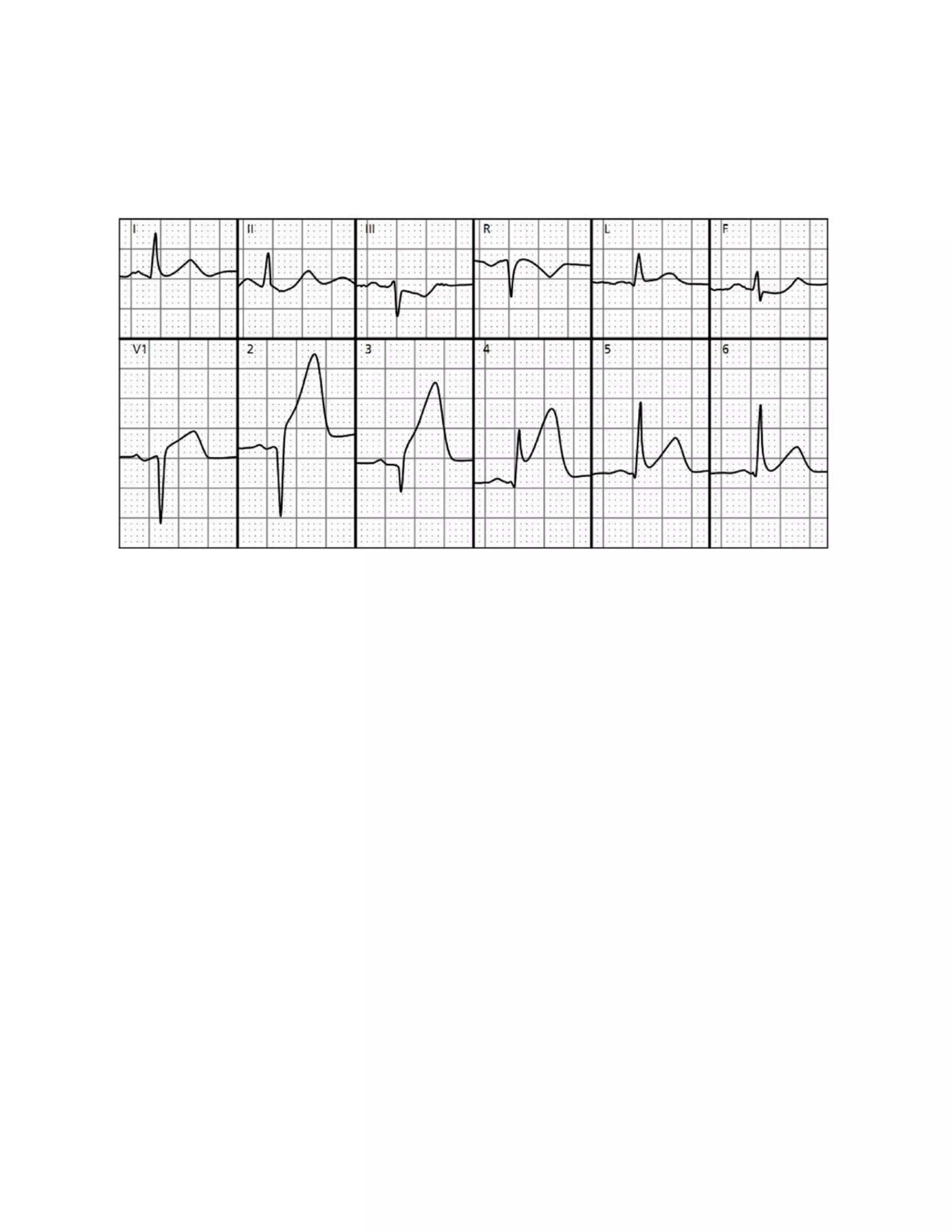 Cac buoc doc ecg | PDF
