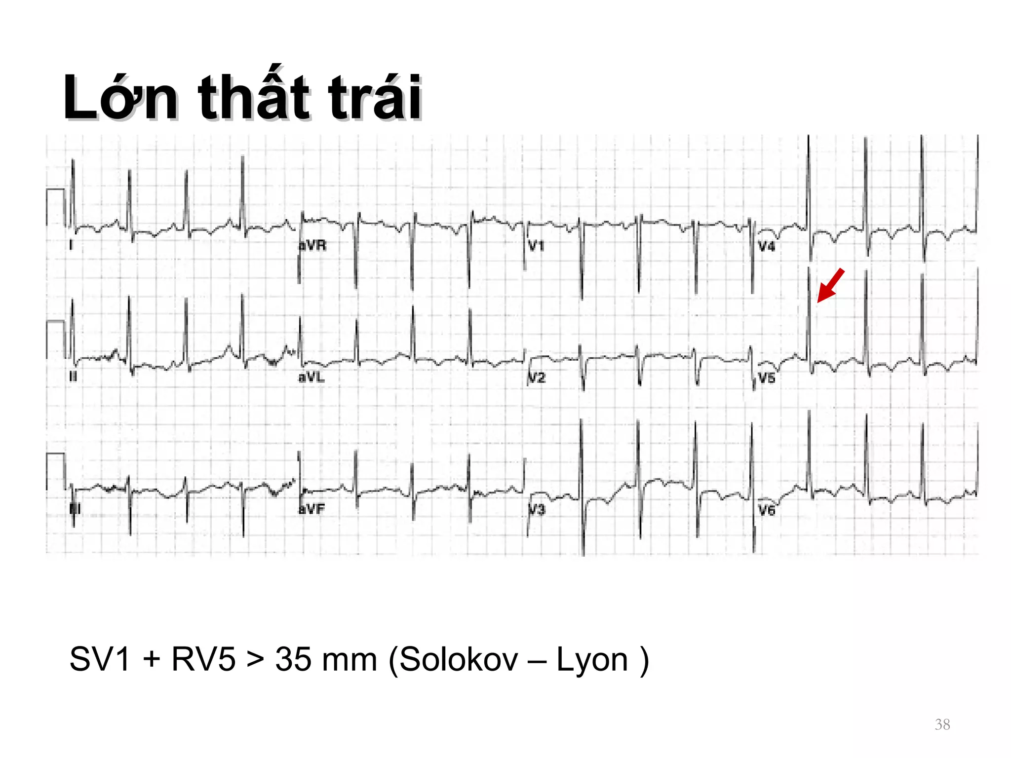 Các bước đọc điện tâm đồ ECG | PPT
