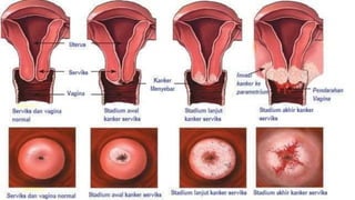 Ca cerviks | PPT