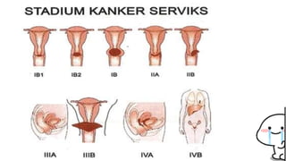 Ca cerviks | PPT
