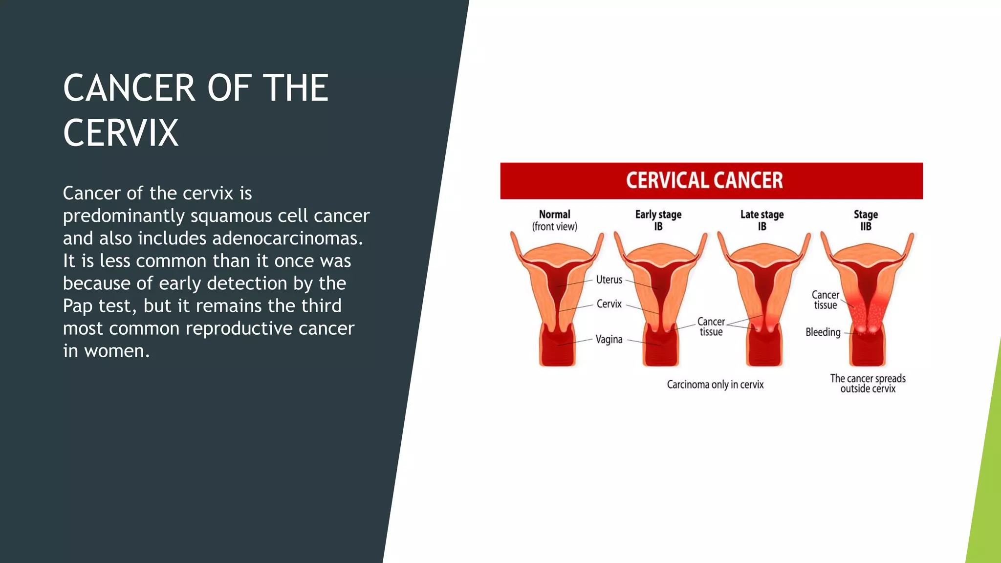 CANCER of Cervix- Easy ppt for Nurses | PDF