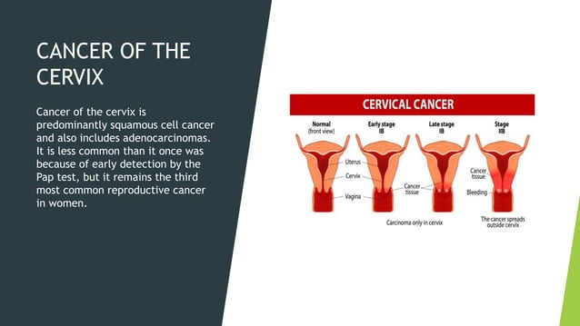 CANCER of Cervix- Easy ppt for Nurses | PDF | Cancer | Diseases and ...